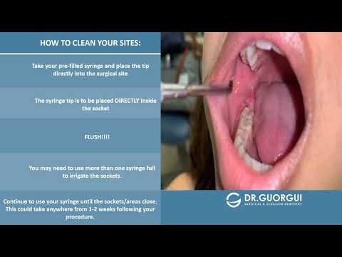 Post-Operative Video: Irrigation for Extraction and Wisdom Teeth