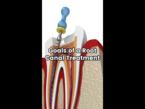 What does a root canal actually fix?