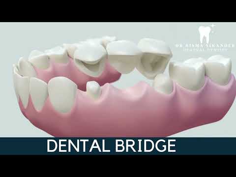 The best Dental Bridge in Doha ,Qatar. For Free Consultation Call us at 50783737.