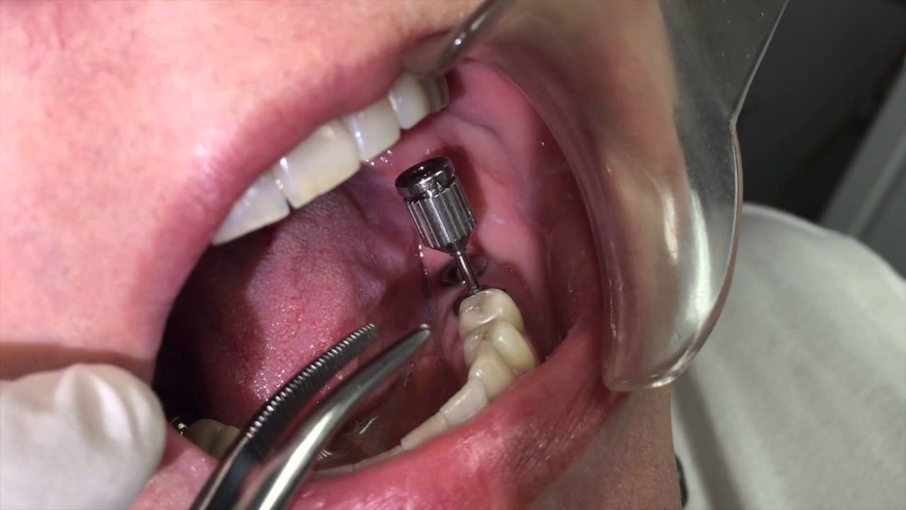 How to Remove a Tight Healing Abutment