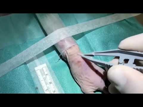 A Large-Size Bioprinted Dermo-Epidermal Substitute For Permanent Wound Coverage