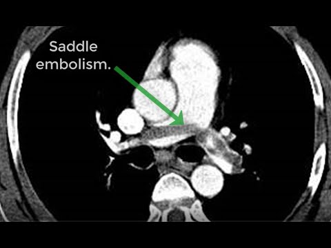 Sub massive and massive Pulmonary Embolism.