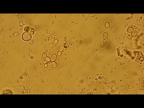 Yeast cells in urine microscopy.