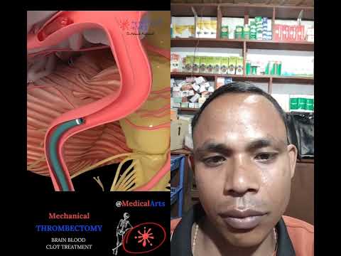 mechanical thrombectomy stroke animation #ischemicstroke #viral #baby #trending #cute #funny #mbbs