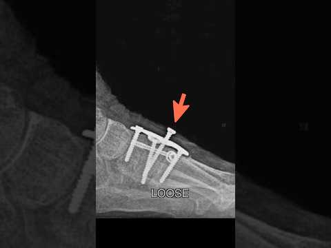 Loose SCREW in foot! #shorts