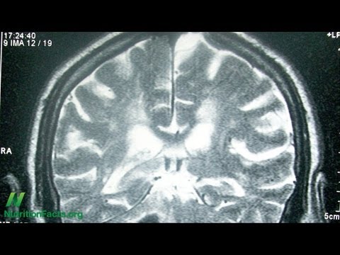 Preventing Strokes with Diet