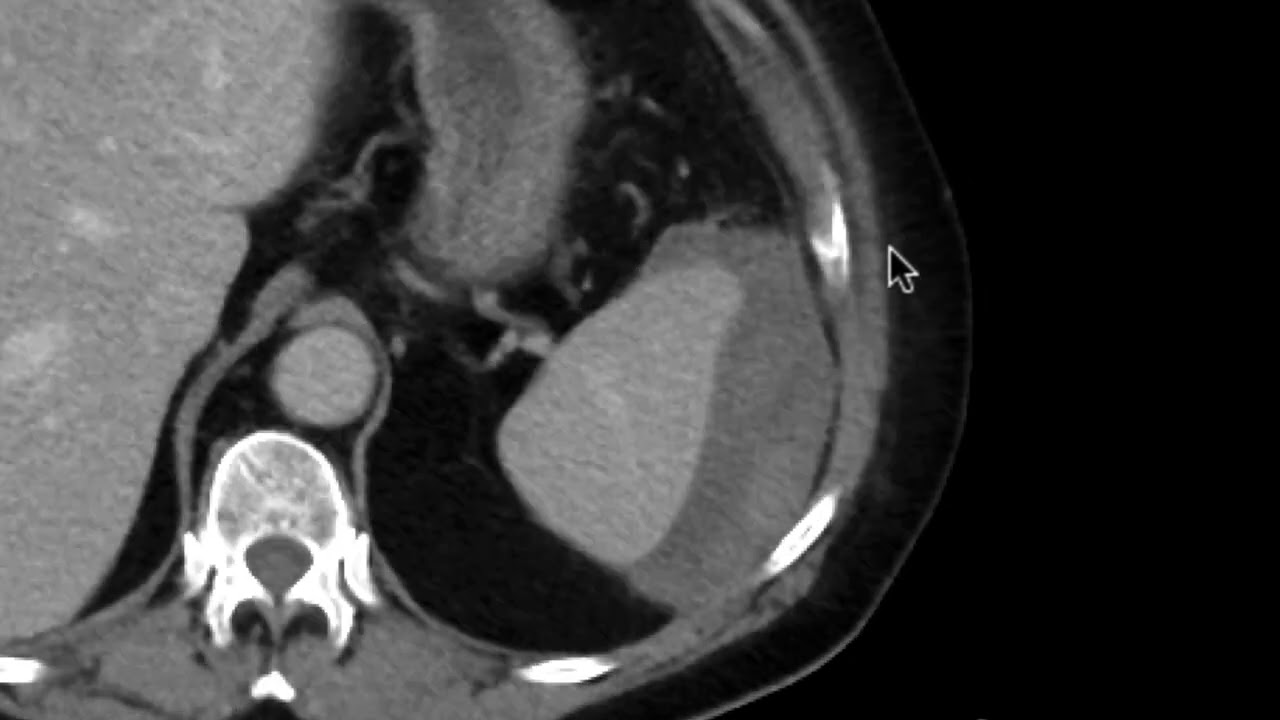 Splenic laceration post colonoscopy