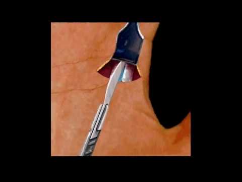 Trigger Finger Surgery