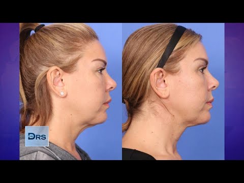 See Woman’s Incredible Results After Defining Jawline Procedure