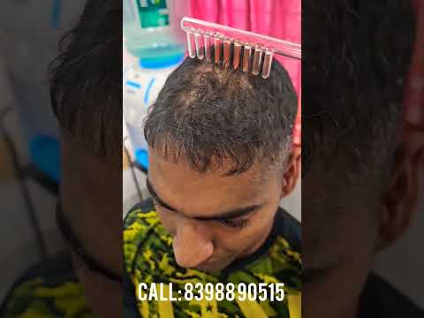 अब बालो का झड़ना रौकना नामुनकिन नहीं. #hairlosstreatment #hairtreatments #baldness #bald #hair