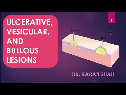 Definition in Oral Mucosal Lesions