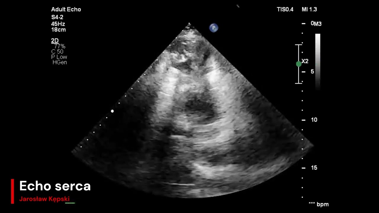 Massive Left Ventricular Apex Thrombus After Silent Myocardial Infarction | Echocardiography Case