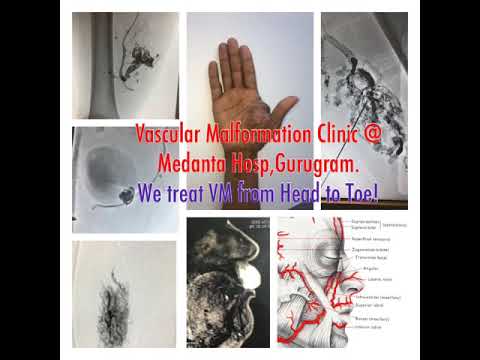 AVM treatment by Dr Sheorain