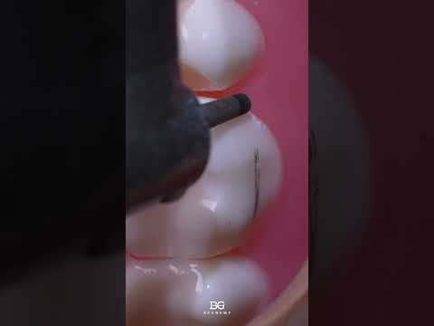 Step-by-Step molar crown prep. #dentistry #dentaleducation #MolarPrep