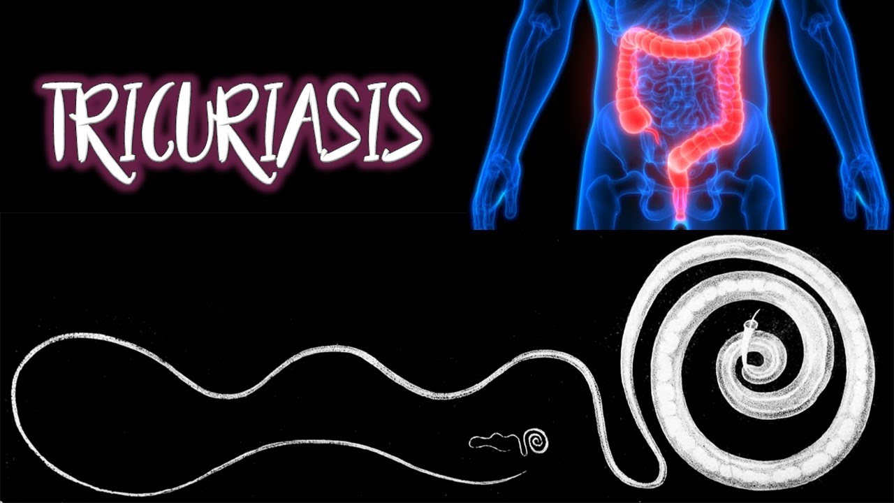 Tricuriasis la Parasitosis del prolapso rectal