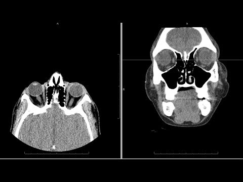 CT (computed tomography) face radiology search pattern