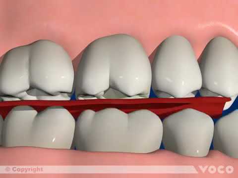GRANDIO SO Inlay system - Interdent trgovina