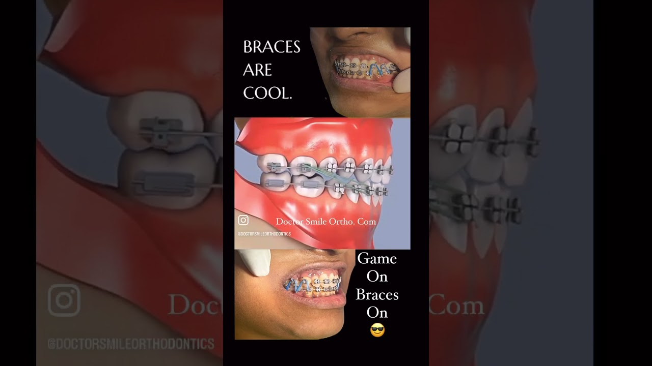 Braces Treatment at Affordable cost in Hyderabad