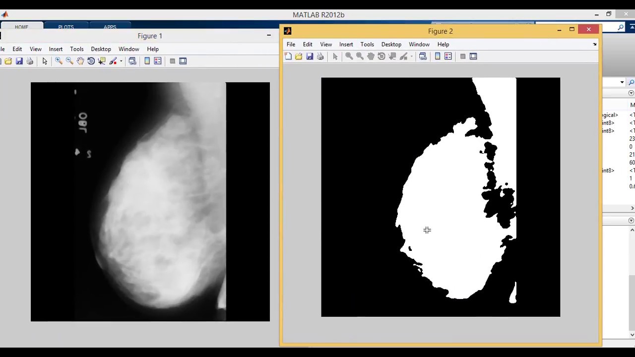 Breast Cancer Detection Using SVM and Feature Extraction