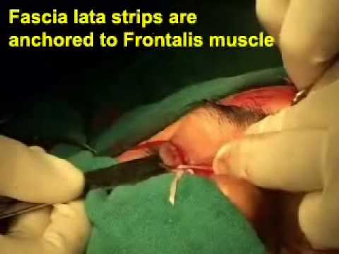 Frontalis sling