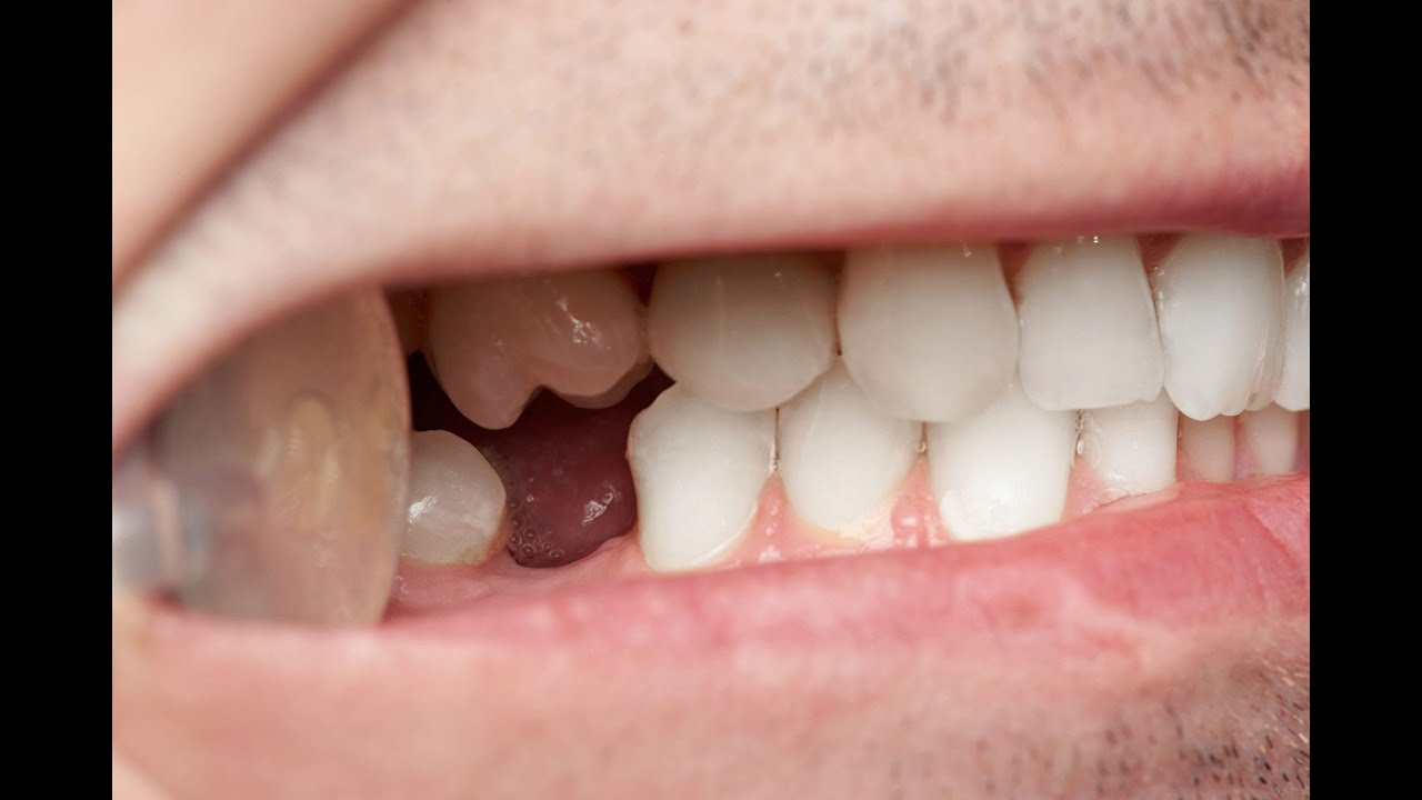 Replacing a Missing Tooth