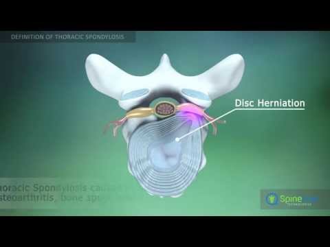 Thoracic Spondylosis Definition