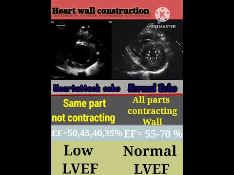heart 🫀Wall contraction & Normal LVEF & Abnormal LVEF #echo short video