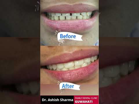 Smile Designing at Family Dental Clinic #smilemakeover #shortsfeed #trending
