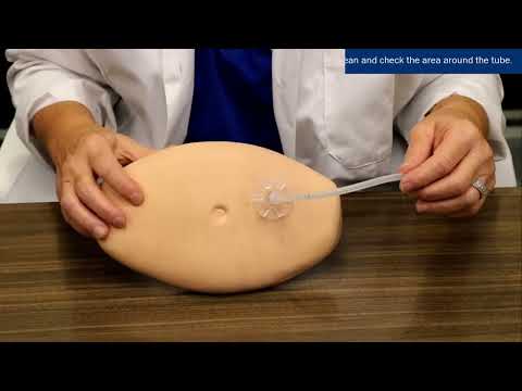 Care of Feeding Tubes (Gastrostomy, Jejunostomy, and Gastro-jejunostomy)