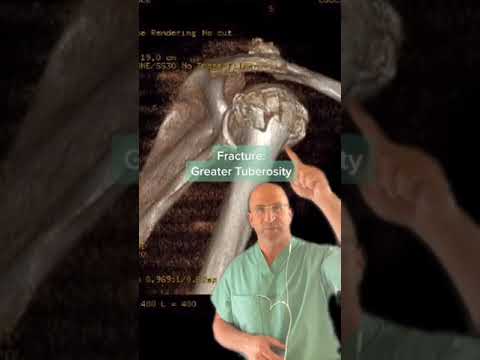 3D Shoulder Fracture #orthopedics #bonefracture #medtech #CTscan #radiology