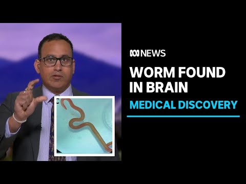 In Australia, ‘live’ 3 inch-long parasitic worm found in woman’s brain ...