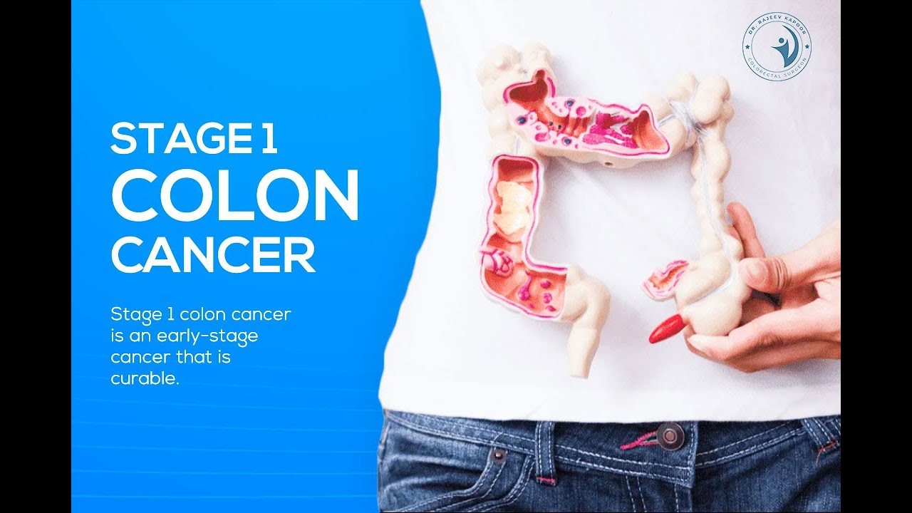 Stage 1 Colon Cancer is an early stage cancer that is curable || Dr. Rajeev Kapoor