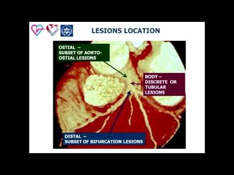 Left main disease : How to add “Angle and Size”to Medina classification ...