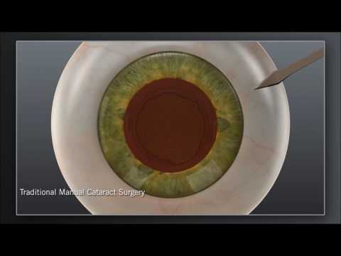 Laser Cataract Surgery with AMO's Catalys® Laser