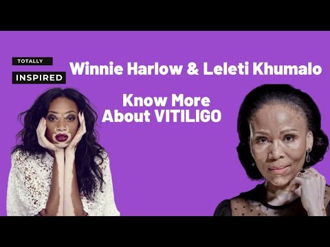 Celebrating Winnie Harlow & Leleti Khumalo | World Vitiligo Day | Totally Inspired with Sibo Dube