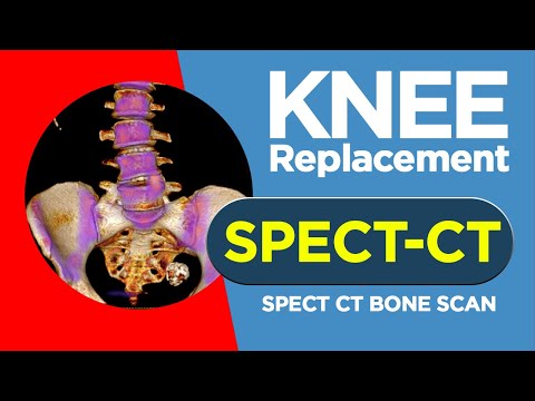 Nuclear Medicine | SPECT-CT | Dr Arum Parthipun | SPECT-CT Bone Scan - Knee Replacement