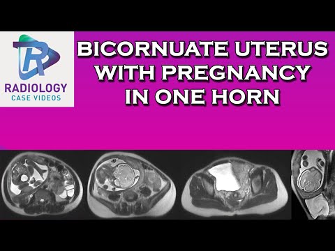 Bicornuate uterus with pregnancy in one horn