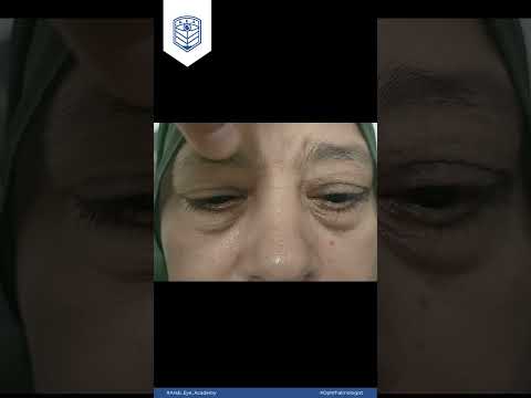 Educational Video 33: Left Limited Abduction (Abducent palsy)