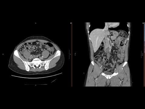 Abdominal Imaging Call Prep Cases: Acute Uncomplicated Appendicitis (CT) Case 2 Discussion