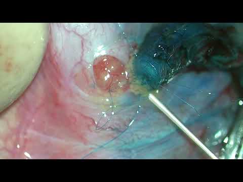 Intrascrotal calculi: potential killer of sperm - Supplementary video 2 [ID 393637]