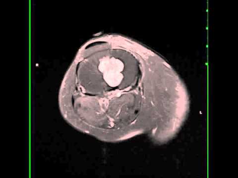 Enchondroma, Tibia