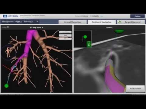 Navigational Brochoscopy Griffin Hospital