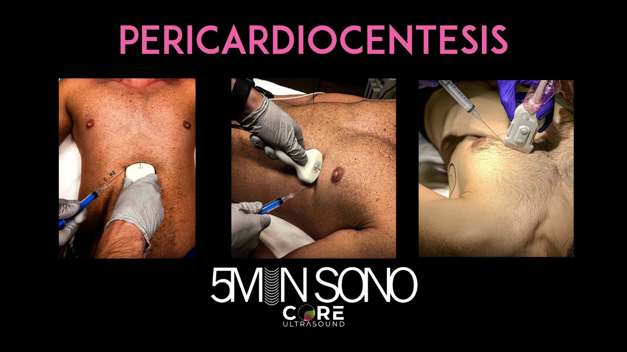 5 Minute Sono - Pericardiocentesis