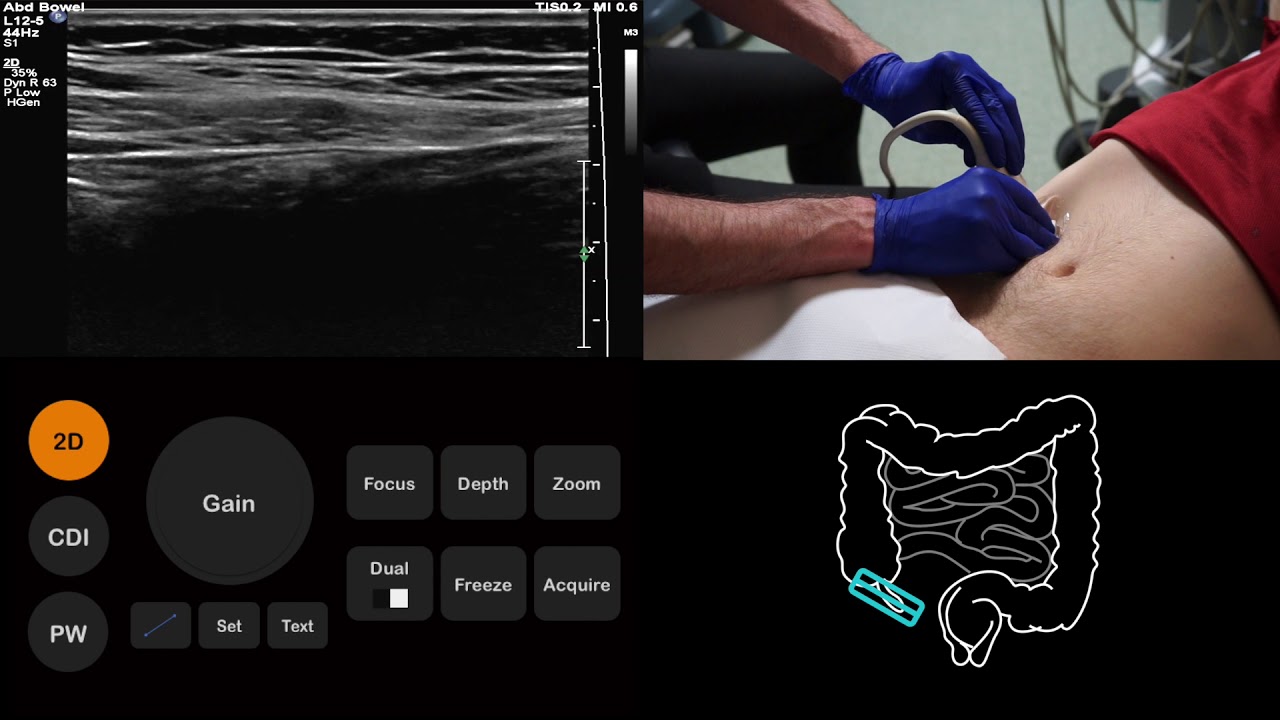 Ultrasound Tutorial: Appendix/Appendicitis (non-audio, text described version) | Radiology Nation