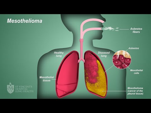 mesothelioma lawsuit settlement amounts - mesothelioma lawsuit settlement amounts