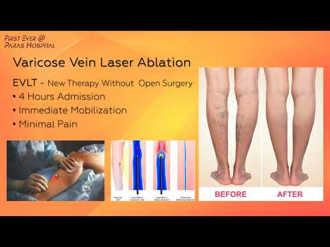 Laser Ablation | Dr. Amit Bhushan Sharma