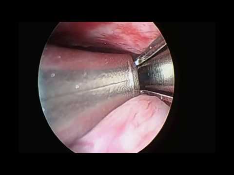 UroLift 2017 - The Prostate Clinic