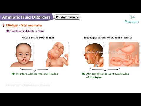 Amniotic Fluid Disorders: Polyhydramnios