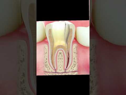 From decaying to Health one process of tooth in 8sec RCT