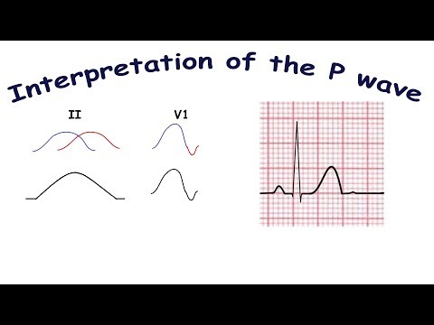 Interpretation of the P wave